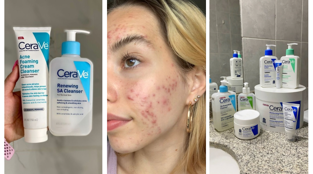 Clear Skin, No Cap: 8 Holy Grail CeraVe Products For Acne That Work ...